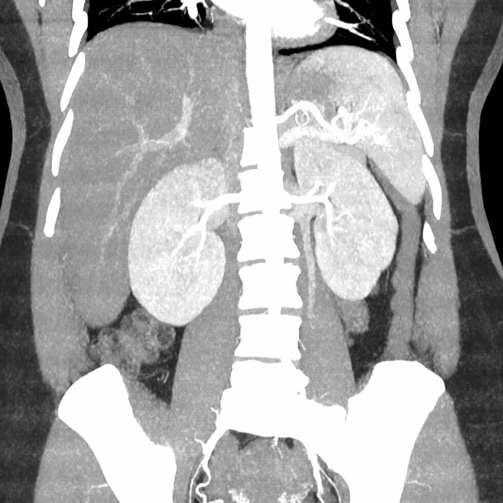 Scanner des Artères Rénales - Scanner Paris